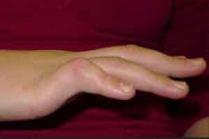 Bent Little Finger: A Secret Sign of ADHD or Autism? - Vast Diversity